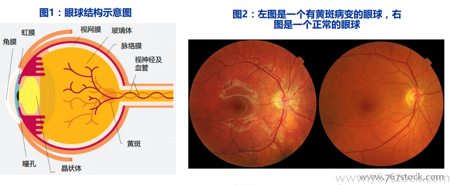 【行业】眼科系列报告-黄斑病变用药（34页）_乐晴智库
